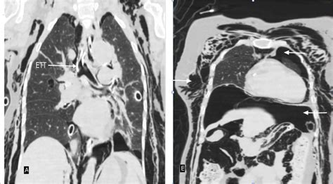 A Ct Chest Showing Ett Just Above The Carina B Ct Scan Showing Download Scientific Diagram