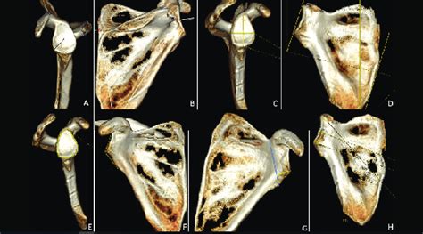Examples Of Measurement Techniques Of Glenoid Plane And Scapular Plane Download Scientific