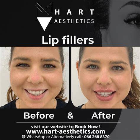 Lip Fillers Before After Hart Aesthetics