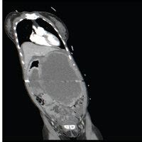 Computed Tomography Findings A Abdominal Computed Tomography CT Download Scientific
