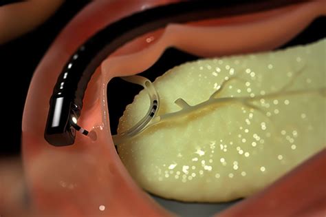 Ercp Endoskopische Retrograde Cholangio Pankreatographie Prof Dr Cengiz Pata