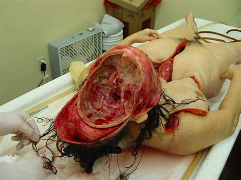 Removal Of Brain At Autopsy This Woman Died From A Tumour In The Left