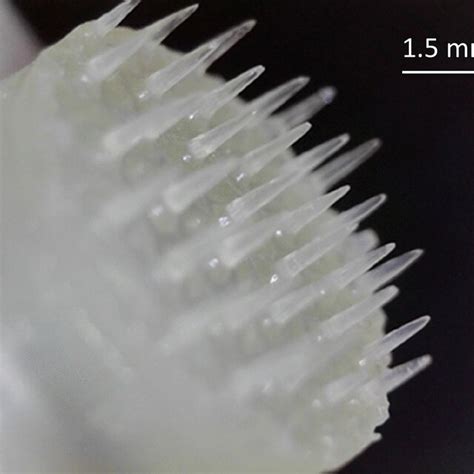 Histology Of Hypertrophic Scar After The Removal Of Dmns Dissolving