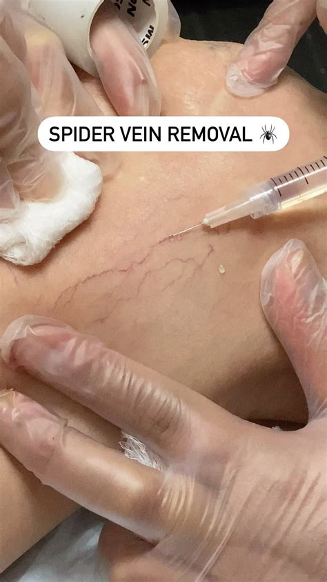 Tips For Getting A V Shaped Or V Line Face Naturally Without Surgery Or Injections Usha