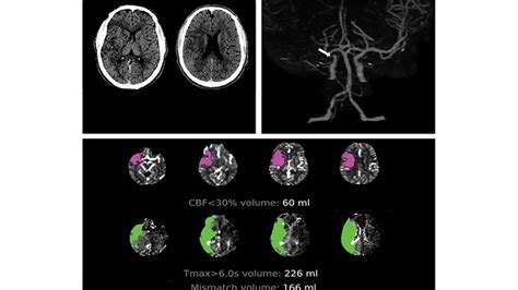 Stroke Snapshot Endovascular Thrombectomy For Stroke Treatm