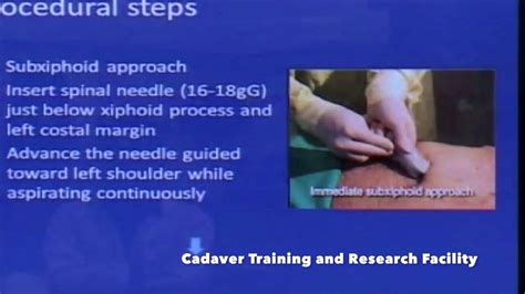 Pericardiocentesis Procedure Clipchamp Keep Youtube