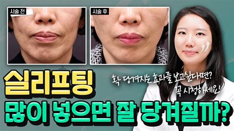실리프팅 몇 줄 정도 넣어야할까요 Feat레이저 리프팅과 차이점 ㅣ 민트실 리프팅 전 꼭 시청하세요 🧐 Youtube