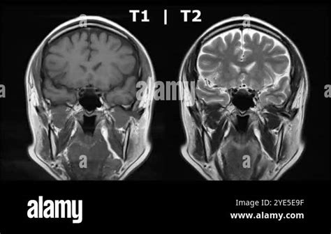 T1 Weighted Mri Stock Videos And Footage Hd And 4k Video Clips Alamy