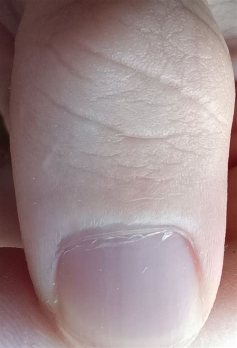 Could That Be Bat Scratch Rmedical