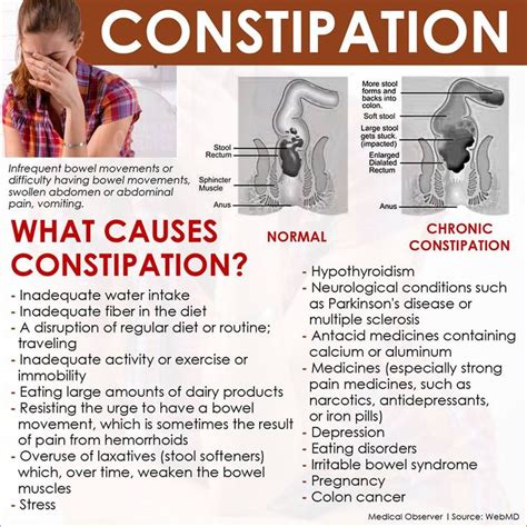 Can Taking Antibiotics Cause Constipation