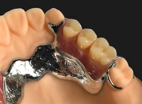 Partial Dentures With Metal Clasps Golden Smile Dental Lab