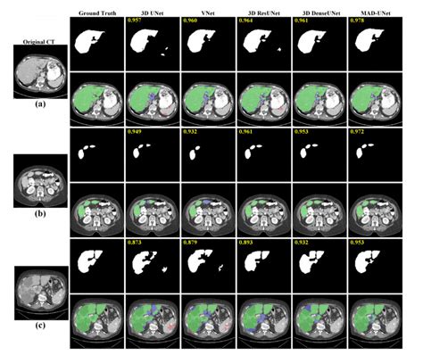 Multi Scale Attention And Deep Supervision Based 3d Unet For Automatic