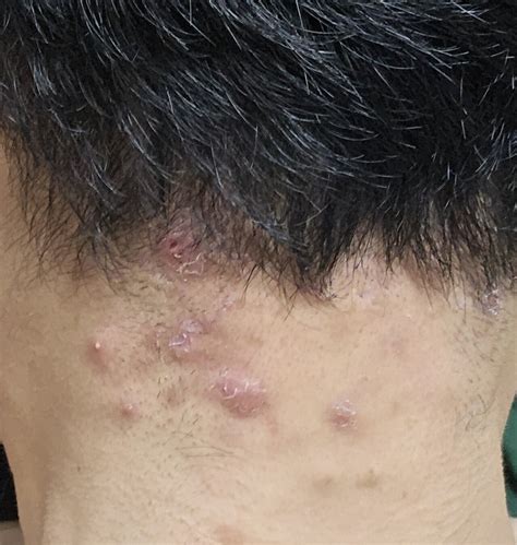 약혐 자기관리로 목드름 드디어 완치분위기 ㅜ 운동 건강 아싸 에펨코리아