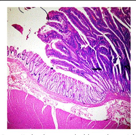 Rectal Prolapse Polyp Histology