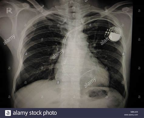 Heart Pacemaker X Ray Stock Photos Heart Pacemaker X Ray Stock Images Alamy