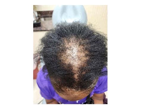 Central Centrifugal Cicatricial Alopecia Ccca Aglow Dermatology