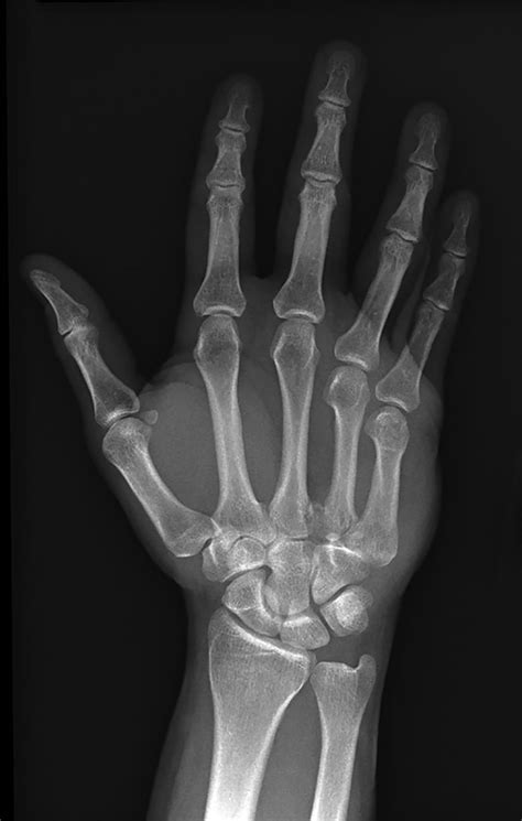 Broken Metacarpal X Ray