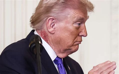 Trump Seen With Mysterious Rash On Neck