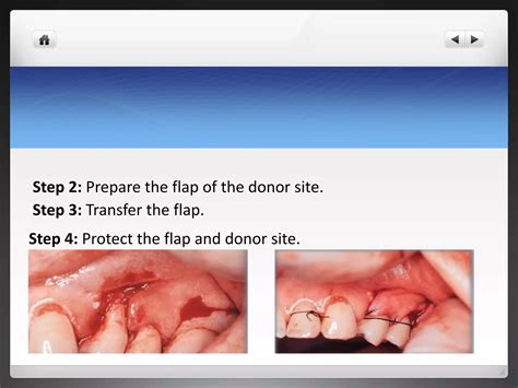 Root Coverage Procedures Pptx