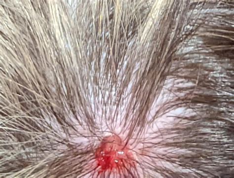 Cant Stop Picking My Scalp R Compulsiveskinpicking