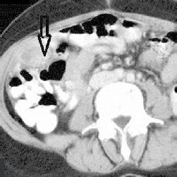 CECT Of The Abdomen In A 45 Year Old Female Patient Shows Rectal GIST Download Scientific