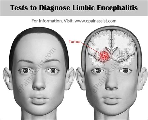 What Is Limbic Encephalitiscausessymptomstreatmentrecovery