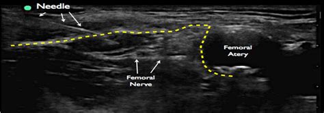 Fascia Iliaca Block For Femoral Fractures