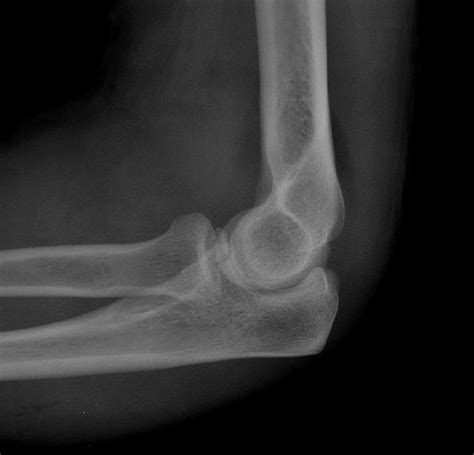 Bone Fracture Detection Object Detection Dataset And Pre Trained Model
