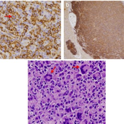 Plasma Cell Tumors And High Grade Splenic Marginal Zone Lymphoma A B