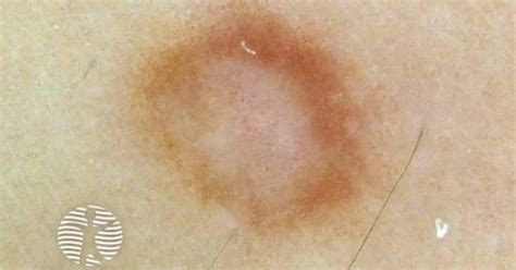 Dermatofibroma Image