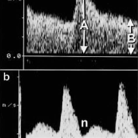 Uterine Artery Waveforms A Normal B Abnormal Resistance