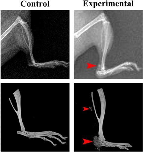 Midpoint Achilles Tendonitis