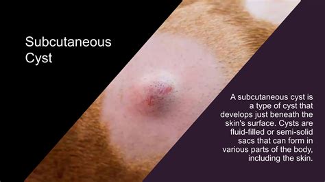 Subcutaneous Cyst And Its Correctionpptx