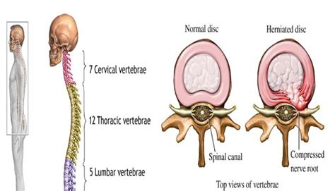 Diagnosing Spinal Disc Herniation