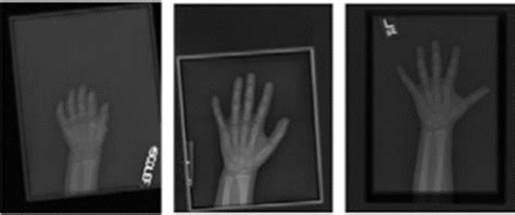 Figure 1 From Bone Age Assessment Based On Deep Learning Architecture