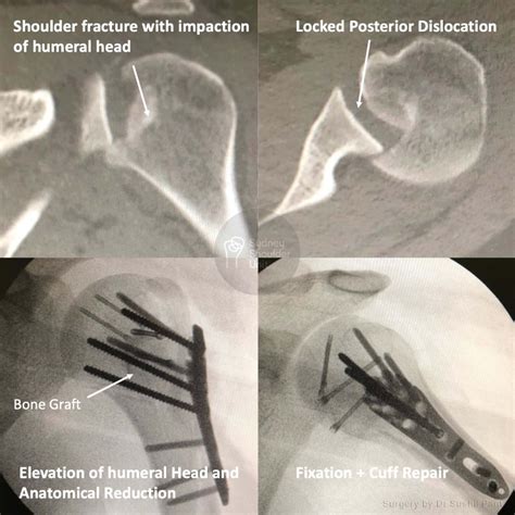 Proximal Humerus Medical Case Study Sydney Shoulder Unit