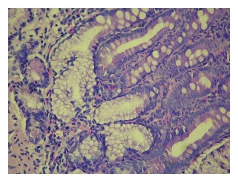 Pyloric Metaplasia At The Base Of The Crypt Handex400 Download