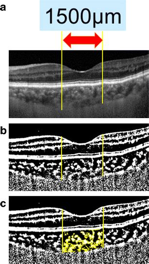 enhanced depth spectral domain optical coherence tomographic images and
