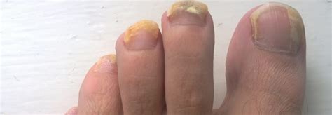 Things About Fungal Nails You Need To Know BackInStride