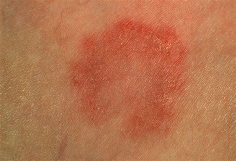 Tinea Corporis Ringworm Lesion On Skin Greeting Card By Dr Chris Hale