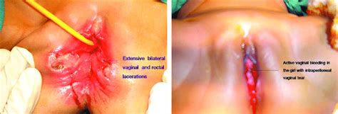 A Extensive Vaginal Lacerations At 5 And 8 O Clock Position In Female Download Scientific