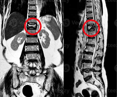 La Resonancia Magnética De La Columna Lumbar Torácica Muestra Una