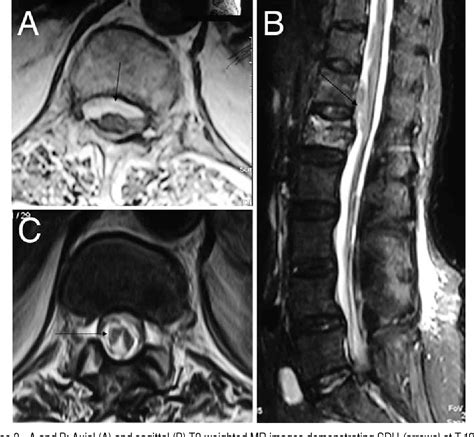 Subdural Effusion Semantic Scholar