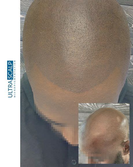Scalp Micropigmentation Tampa Bay Hair Tattoo Lutz Spring Hill Tampa