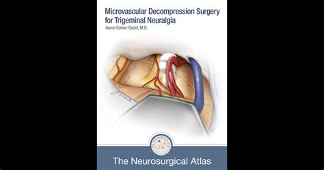 Microvascular Decompression Surgery For Trigeminal Neuralgia By Aaron