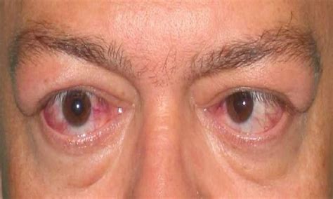 Thyroid Eye Disease Photos Thyroid Eye Disease Diseases Club Center 2