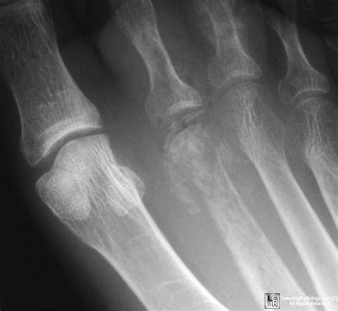 Osteomyelitis X Ray Jaw