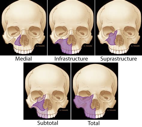 Maxilla Gross Pathology Manual