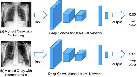 Using Convolutional Neural Networks In Tensorflow To Analyse Chest Xrays