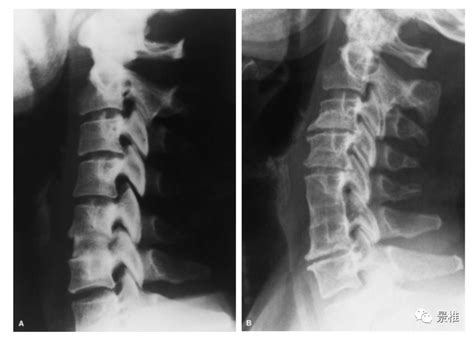 【骨科小技巧】颈椎邻椎病的goffin分型 德医医学 助力医学教育发展！
